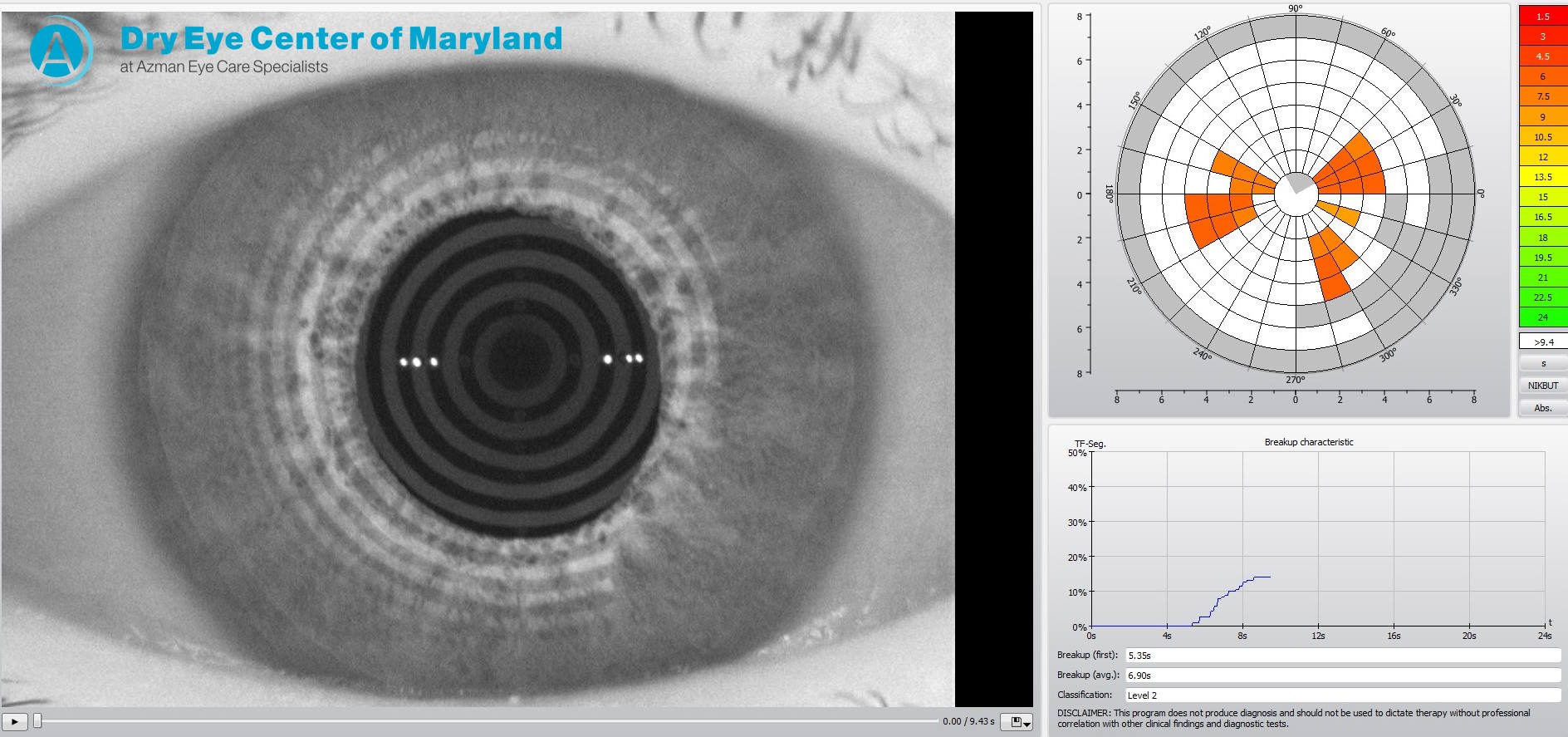 Dry Eye Treatment in Owings Mills, MD - Dry Eye Center of Maryland